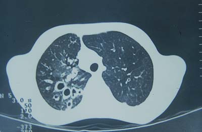 Mukowiscydoza - Diagnostyka w pediatrii - Diagnostyka obrazowa - Atlasy ...